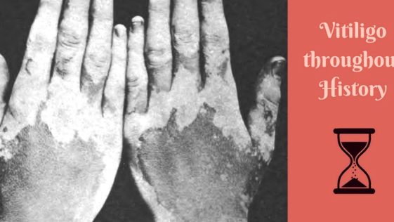 Vitiligo in Animals – All you need to know – Unite For Vitiligo