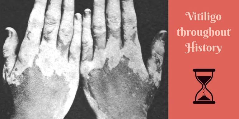 Vitiligo Throughout History And Cultures Unite For Vitiligo