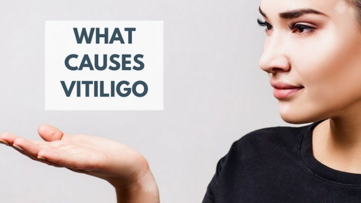 Vitiligo in Animals – All you need to know – Unite For Vitiligo