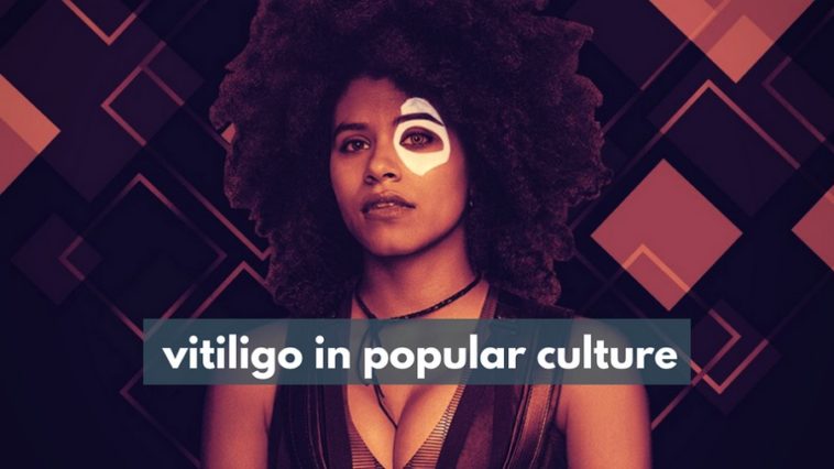 19 Celebrities who talked about their Vitiligo openly – Unite For Vitiligo
