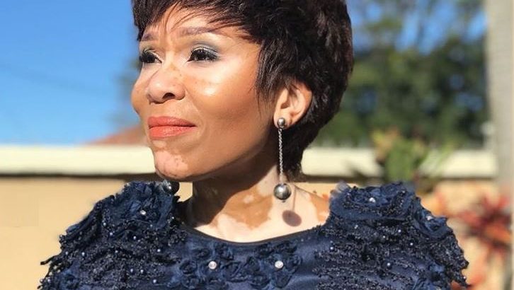 Amy Deanna becomes CoverGirl’s first model with vitiligo. 5 Key ...