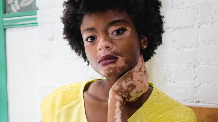 Barbie Goes Inclusive Mattel Launches A Doll With Vitiligo