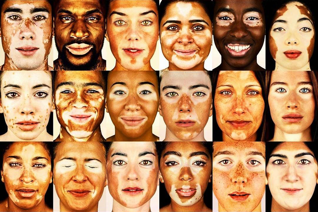 Brock Elbank concludes widely celebrated Vitiligo Portrait Series ...