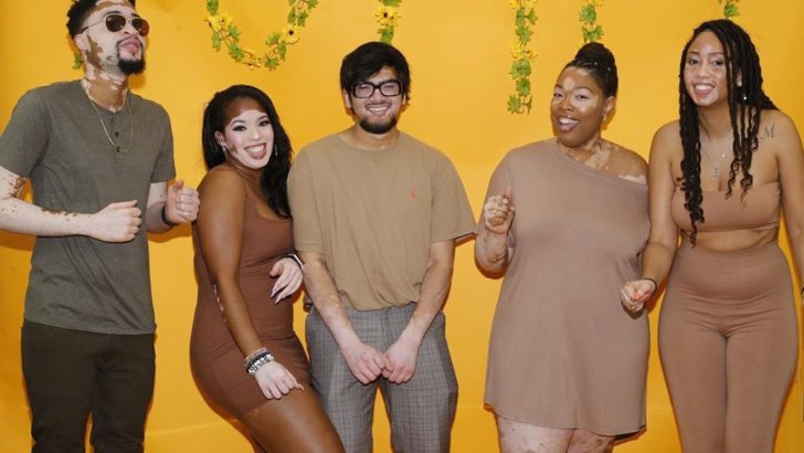 All you need to know about Universal Vitiligo – Unite For Vitiligo