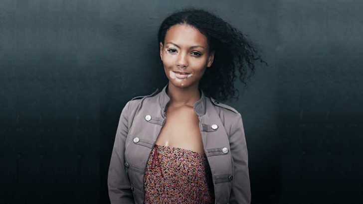 5 Empowering Quotes to motivate Vitiligo Fighters – Unite For Vitiligo