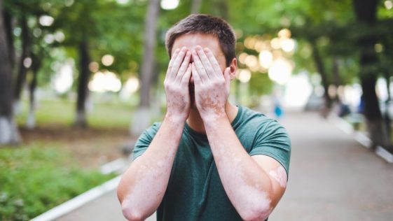 5 Empowering Quotes to motivate Vitiligo Fighters – Unite For Vitiligo
