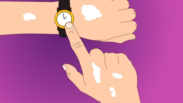 5 Empowering Quotes to motivate Vitiligo Fighters – Unite For Vitiligo