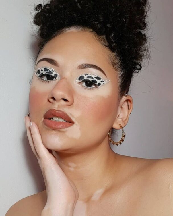 Vitiligo in News – August 2020 – Unite For Vitiligo