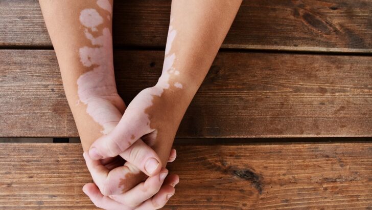 Skin Cancer Observed More in Vitiligo Patients Receiving Phototherapy ...