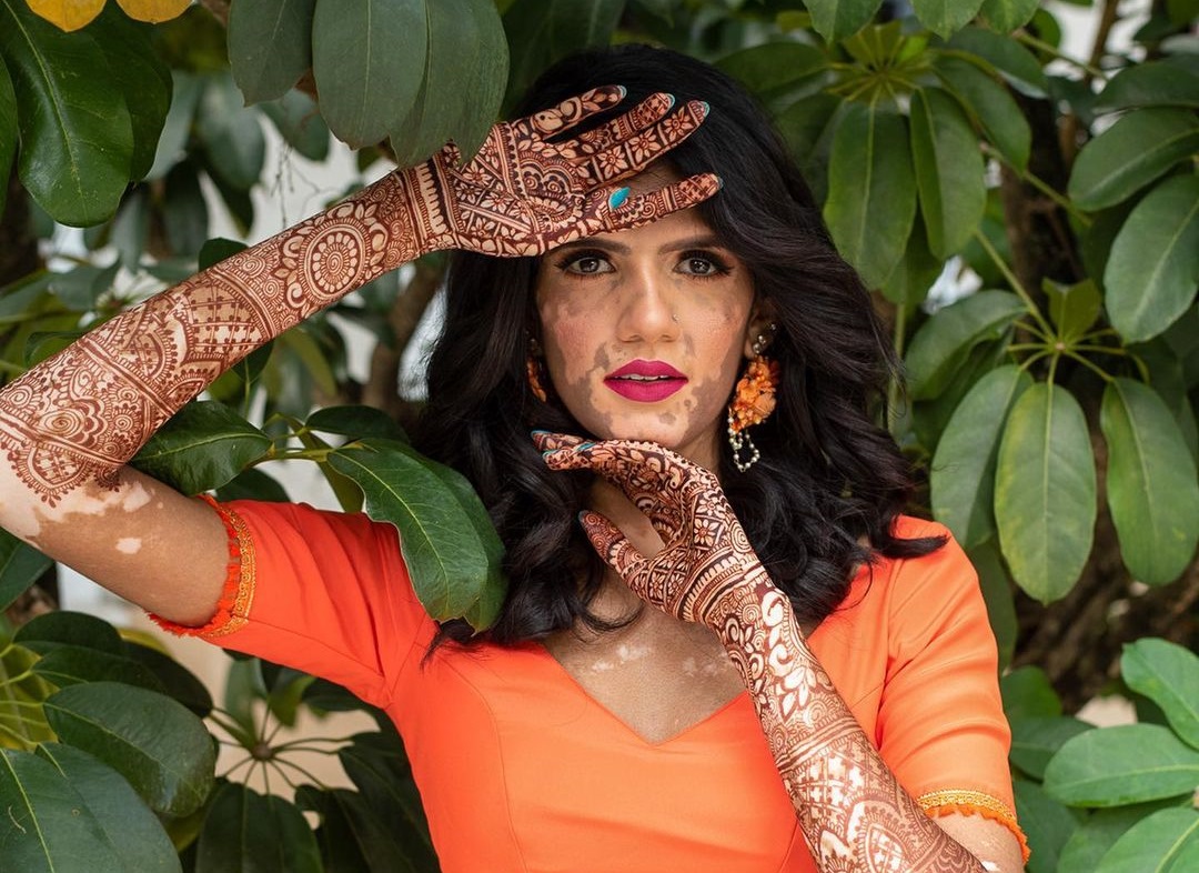 Sonya Charles Danita’s Impactful Vitiligo Journey – Unite For Vitiligo