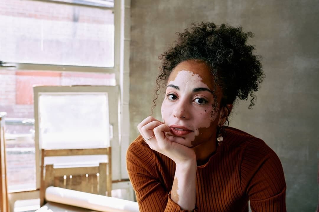 10 Most Influential Vitiligans | 2021 – Unite For Vitiligo