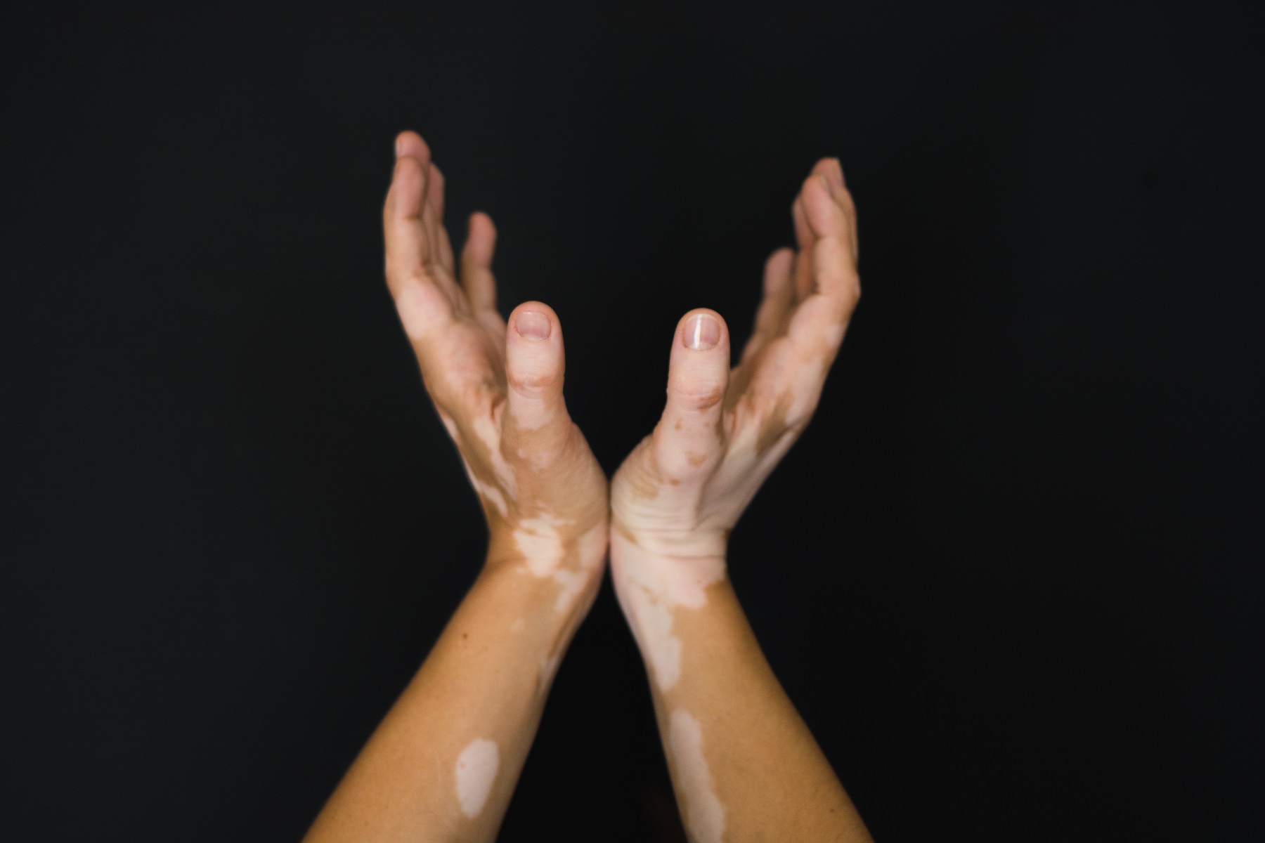 4 Poems That Will Motivate You to Thrive With Vitiligo – Unite For Vitiligo