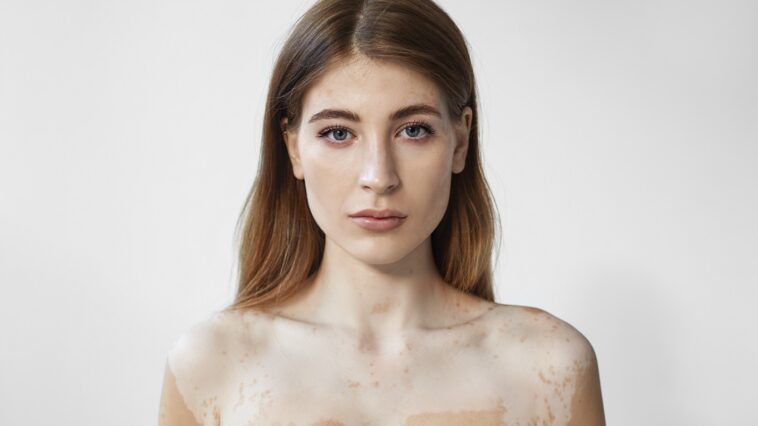 Winnie Harlow becomes the first model with vitiligo to walk the ramp ...