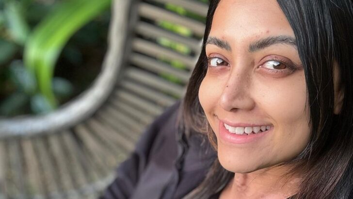 Famous Vitiligans – 56 Celebrities with Vitiligo – Unite For Vitiligo