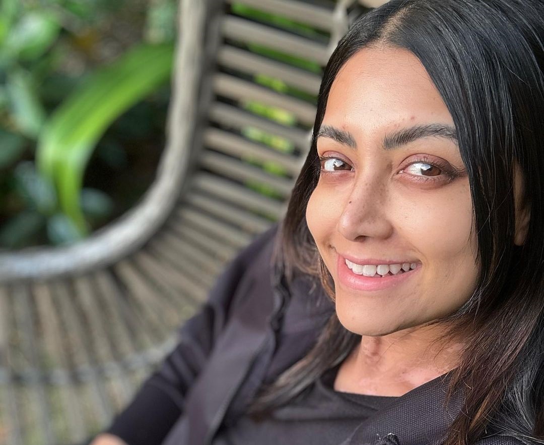 Mamta Mohandas Confirms Diagnosis of Vitiligo and publishes a Message ...