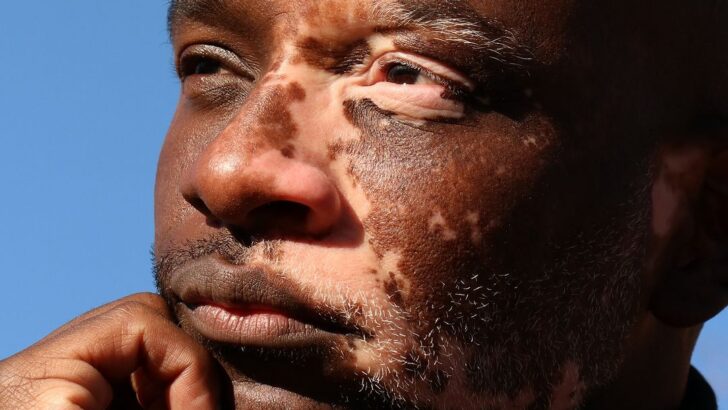 All you need to know about Vitiligo Extent Score – Unite For Vitiligo