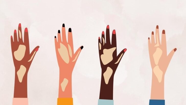 Outshining Vitiligo – 31 Famous Models with Vitiligo – Unite For Vitiligo