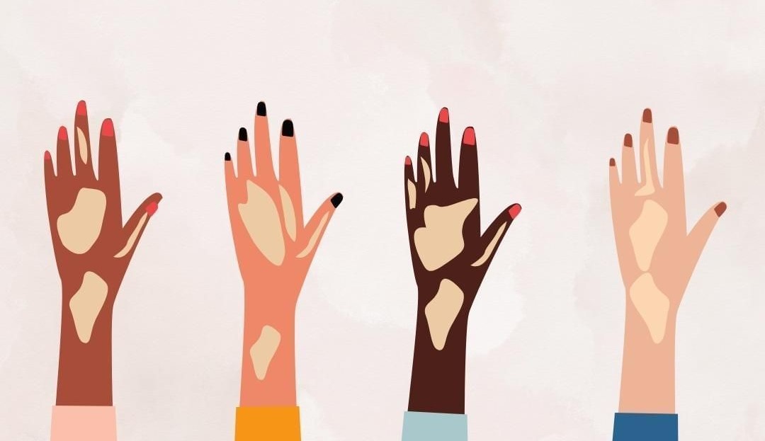 World Vitiligo Day 2024 – A Recap – Unite For Vitiligo