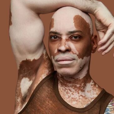 10 Most Influential Vitiligans | 2024 – Unite For Vitiligo